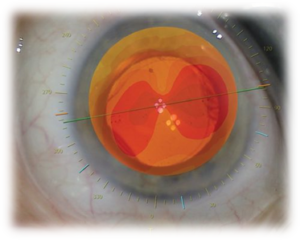 IOL Guidance Systems – DMI Medical USA