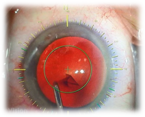 IOL Guidance Systems – DMI Medical USA